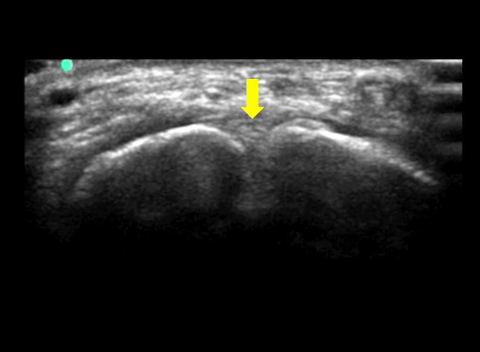 Ecografia musculoscheletală - regiunea radio-carpiană (regiunea ...